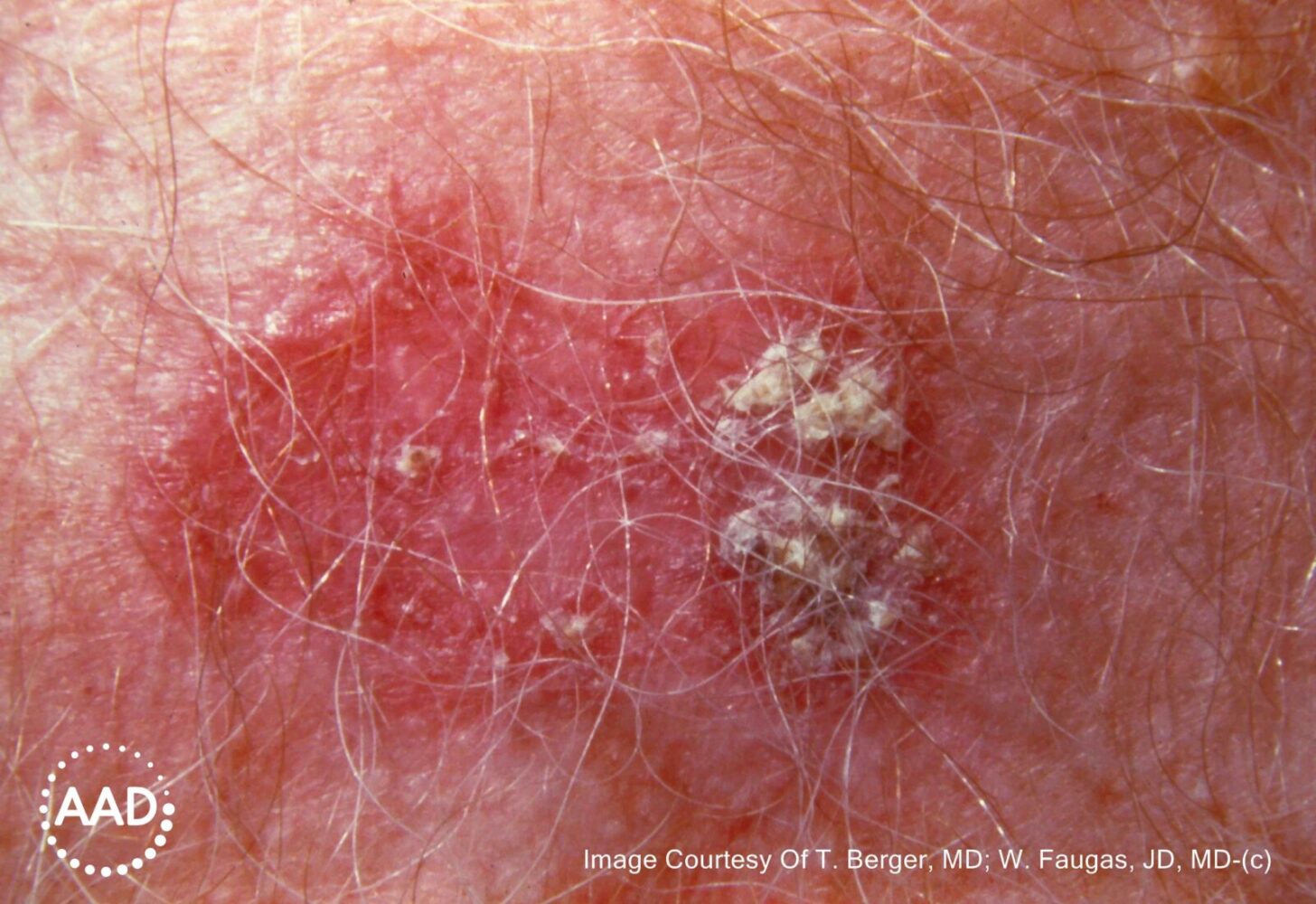 Squamous Cell Carcinoma Symptoms Causes And Treatment